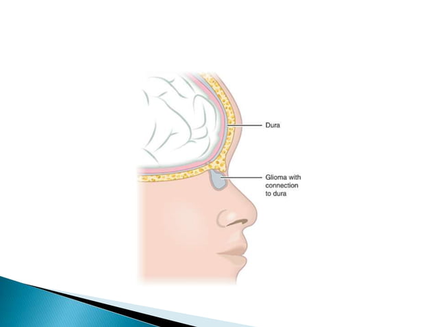 congenital anomalies of nose and PNS.pptx | Ear, Nose and Throat ...