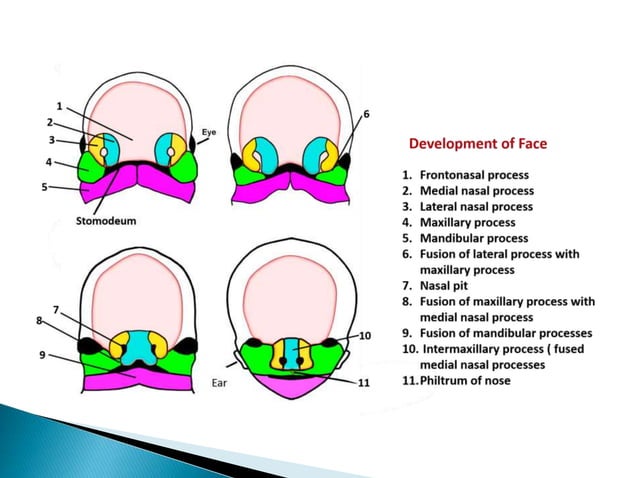 congenital anomalies of nose and PNS.pptx | Ear, Nose and Throat ...