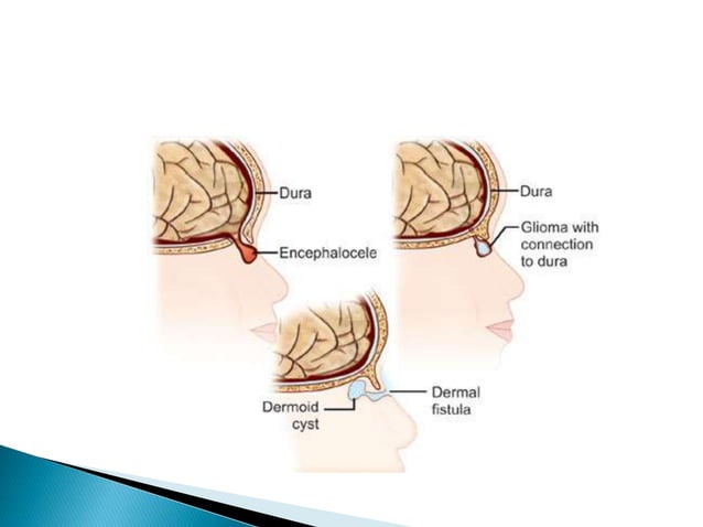 congenital anomalies of nose and PNS.pptx | Ear, Nose and Throat ...