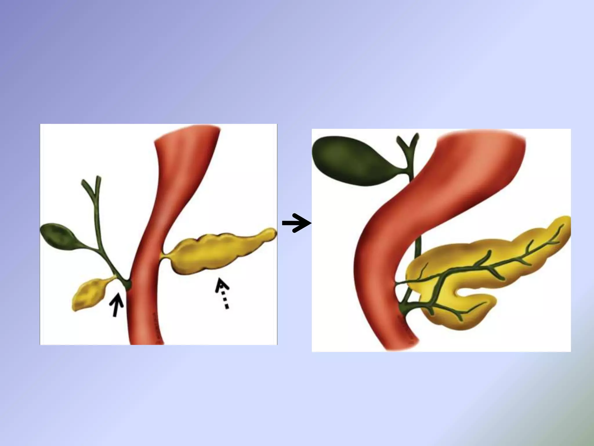 Congenital anomalies of pancreas and hepatobiliary system radiology | PPTX