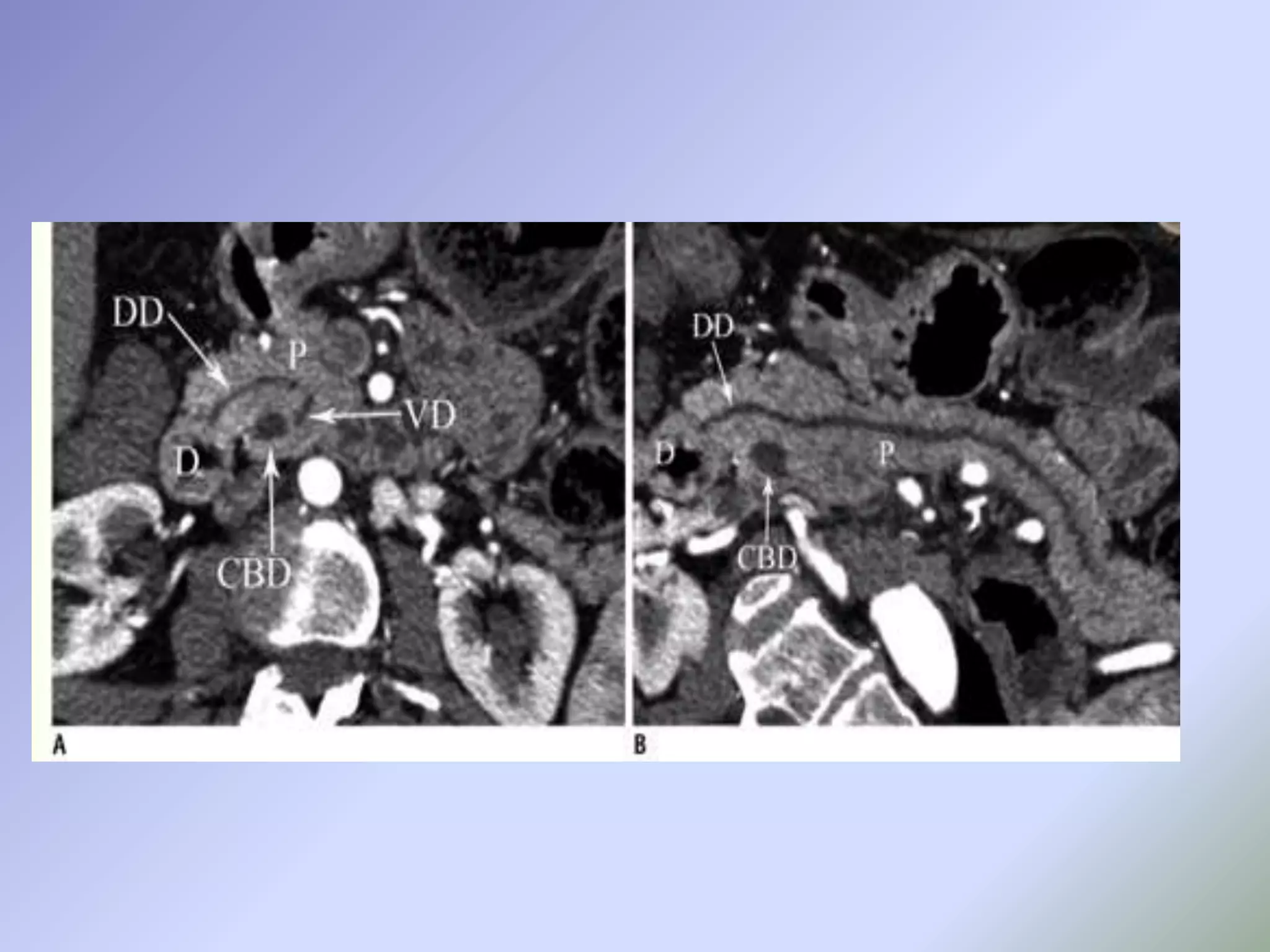 Congenital anomalies of pancreas and hepatobiliary system radiology | PPTX