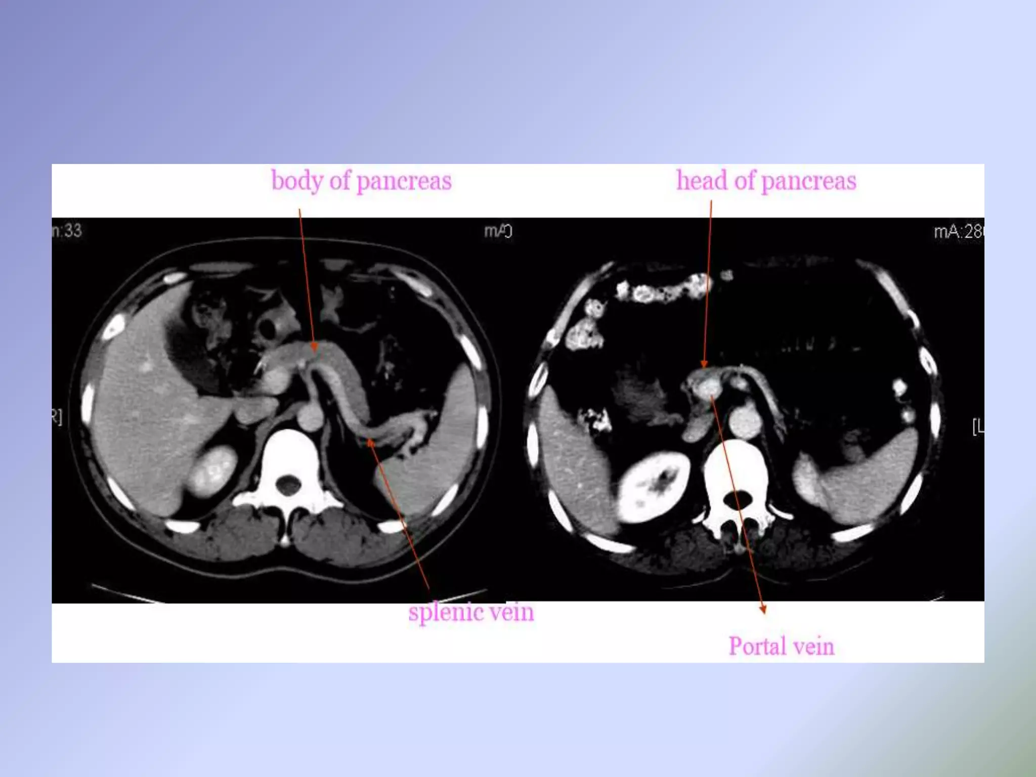 Congenital anomalies of pancreas and hepatobiliary system radiology | PPTX