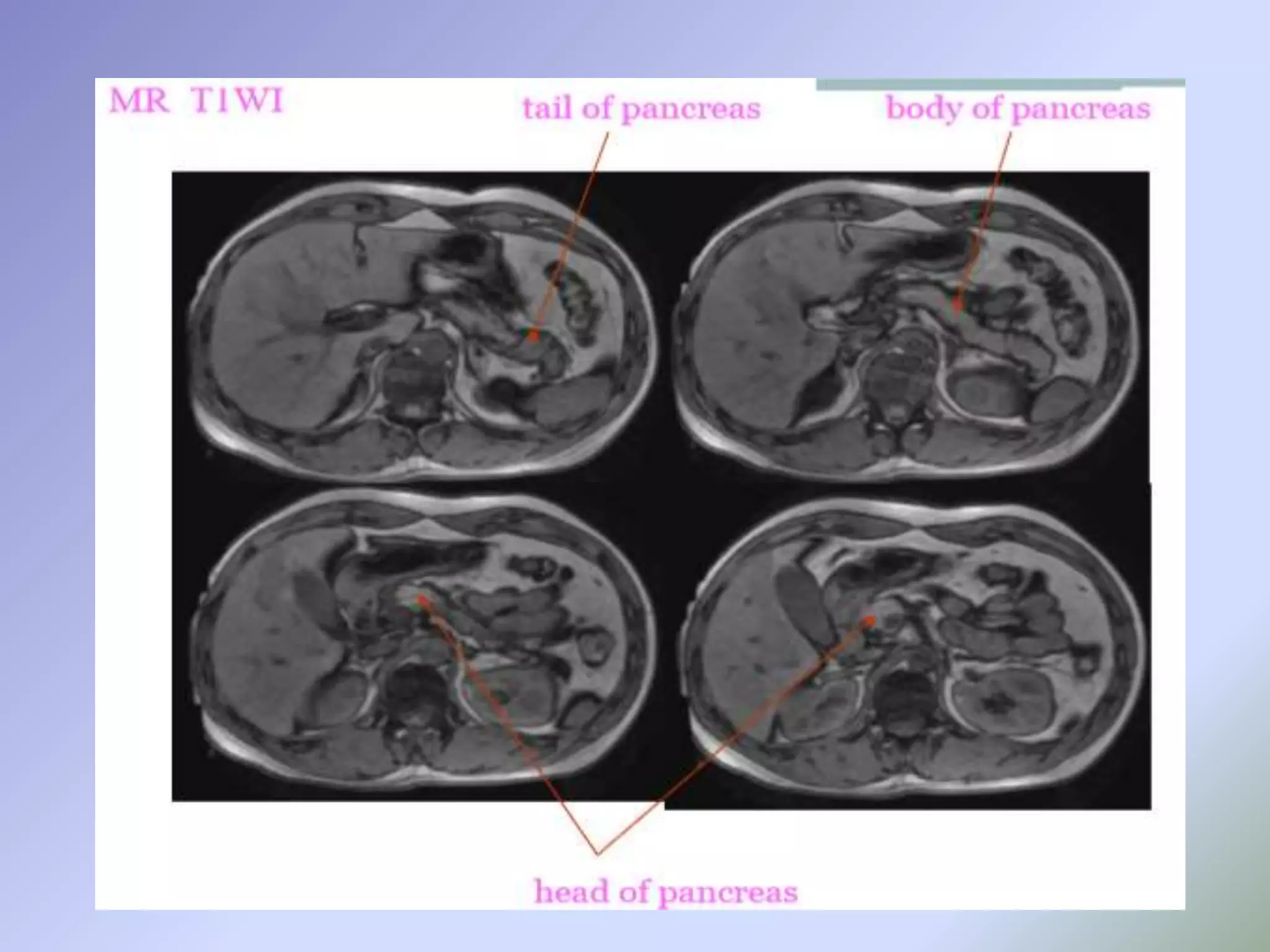 Congenital anomalies of pancreas and hepatobiliary system radiology | PPTX