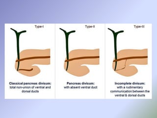 Pancreatic Divisum Radiology