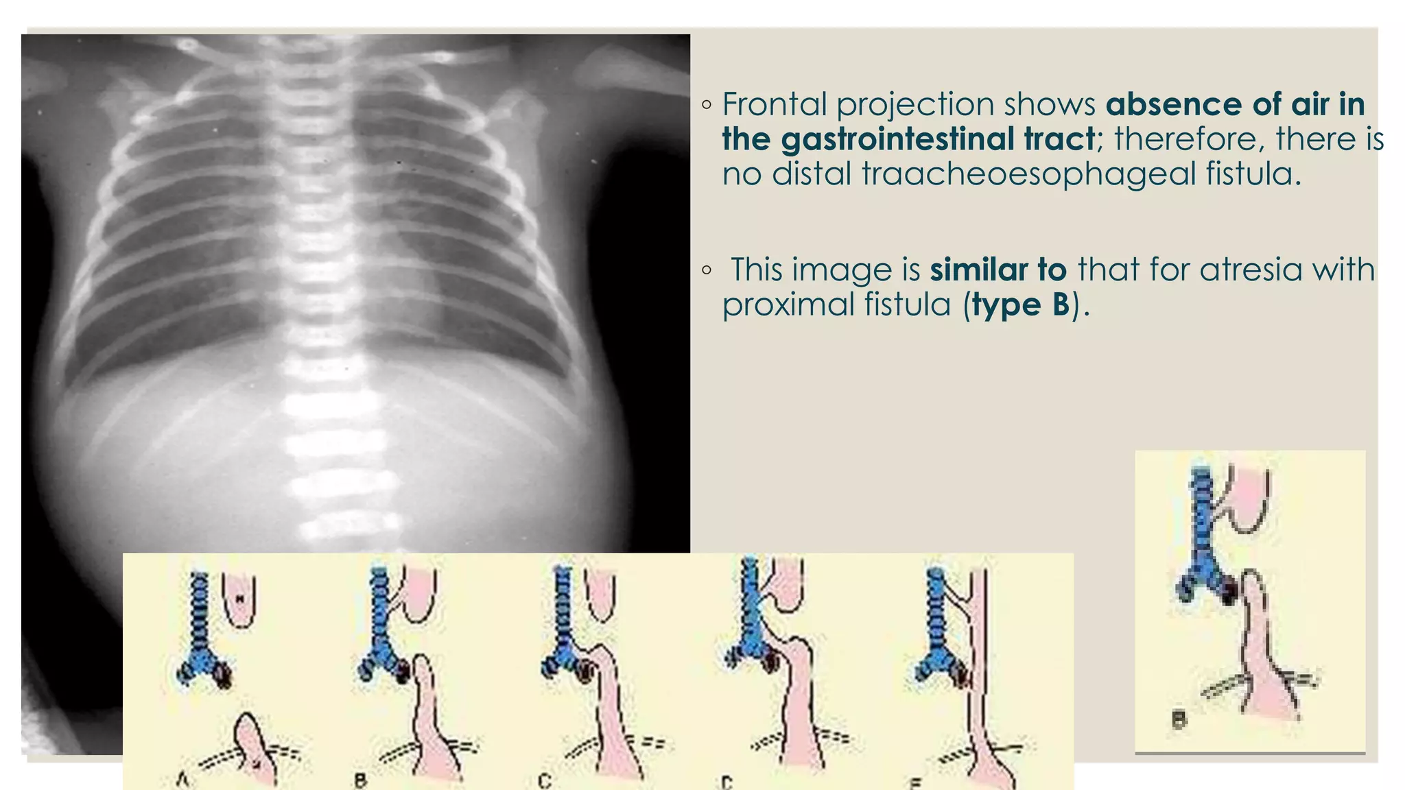 Congenital anomalies of respiratory system A Radiological approach | PDF