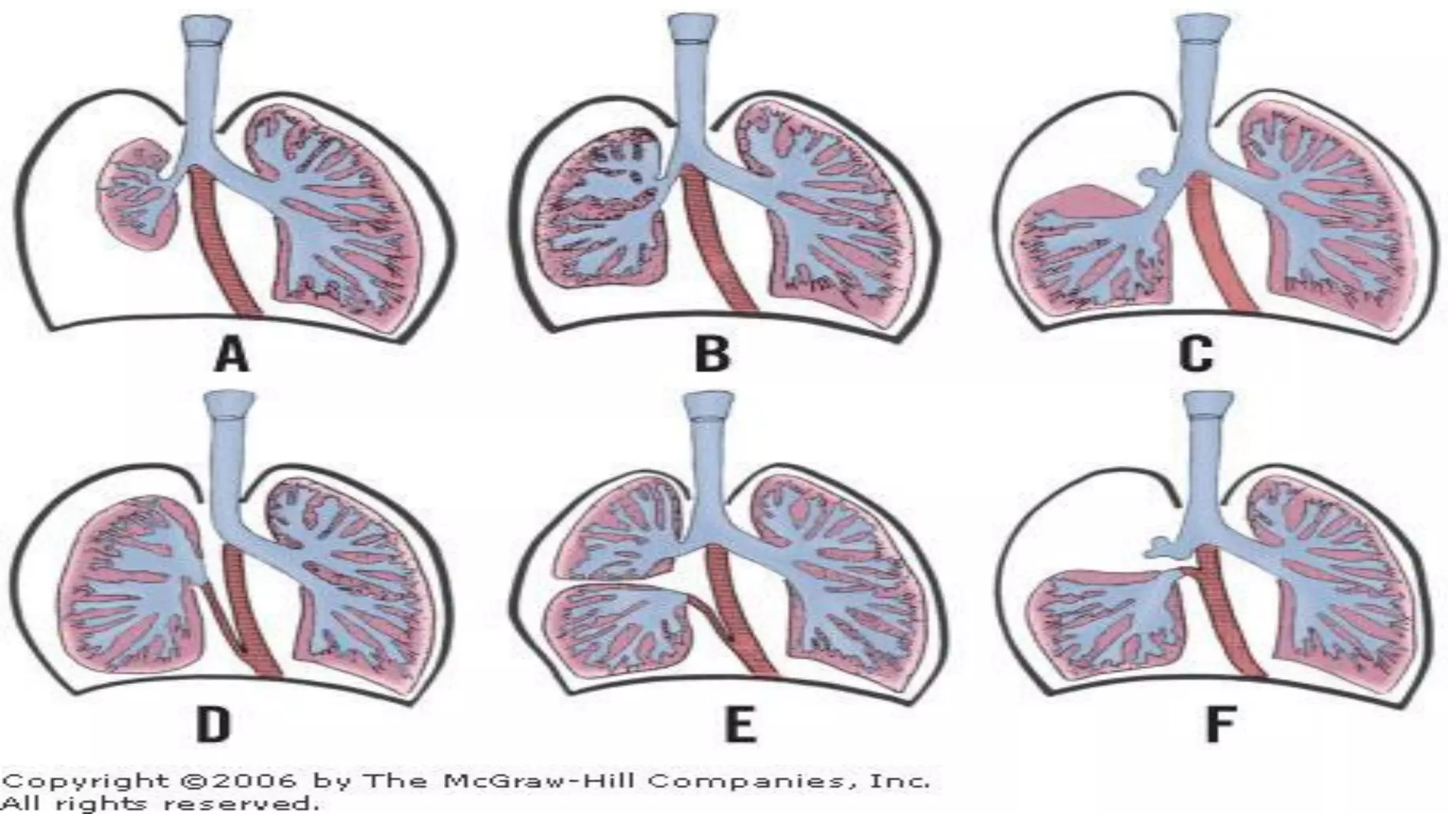 Congenital anomalies of respiratory system A Radiological approach | PDF