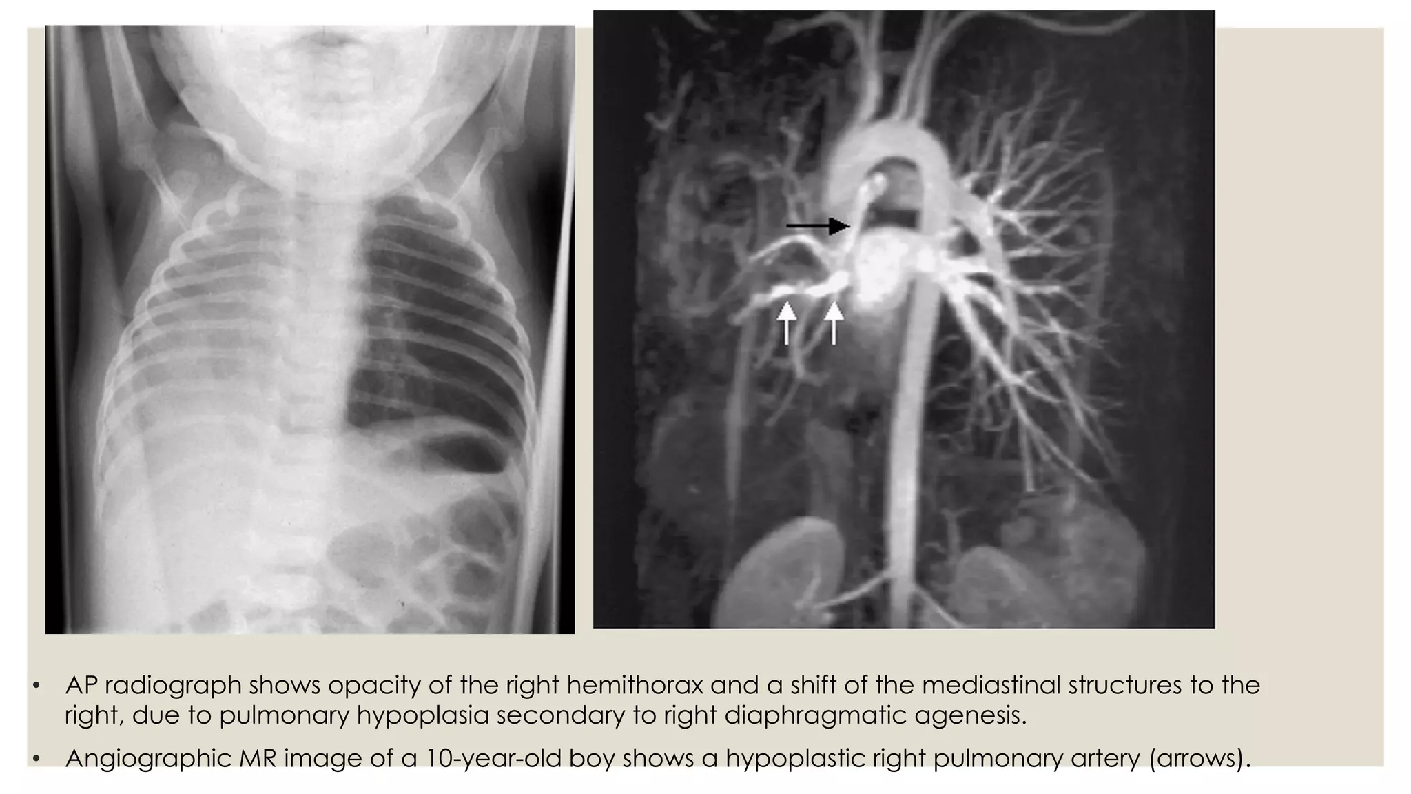 Congenital anomalies of respiratory system A Radiological approach | PDF