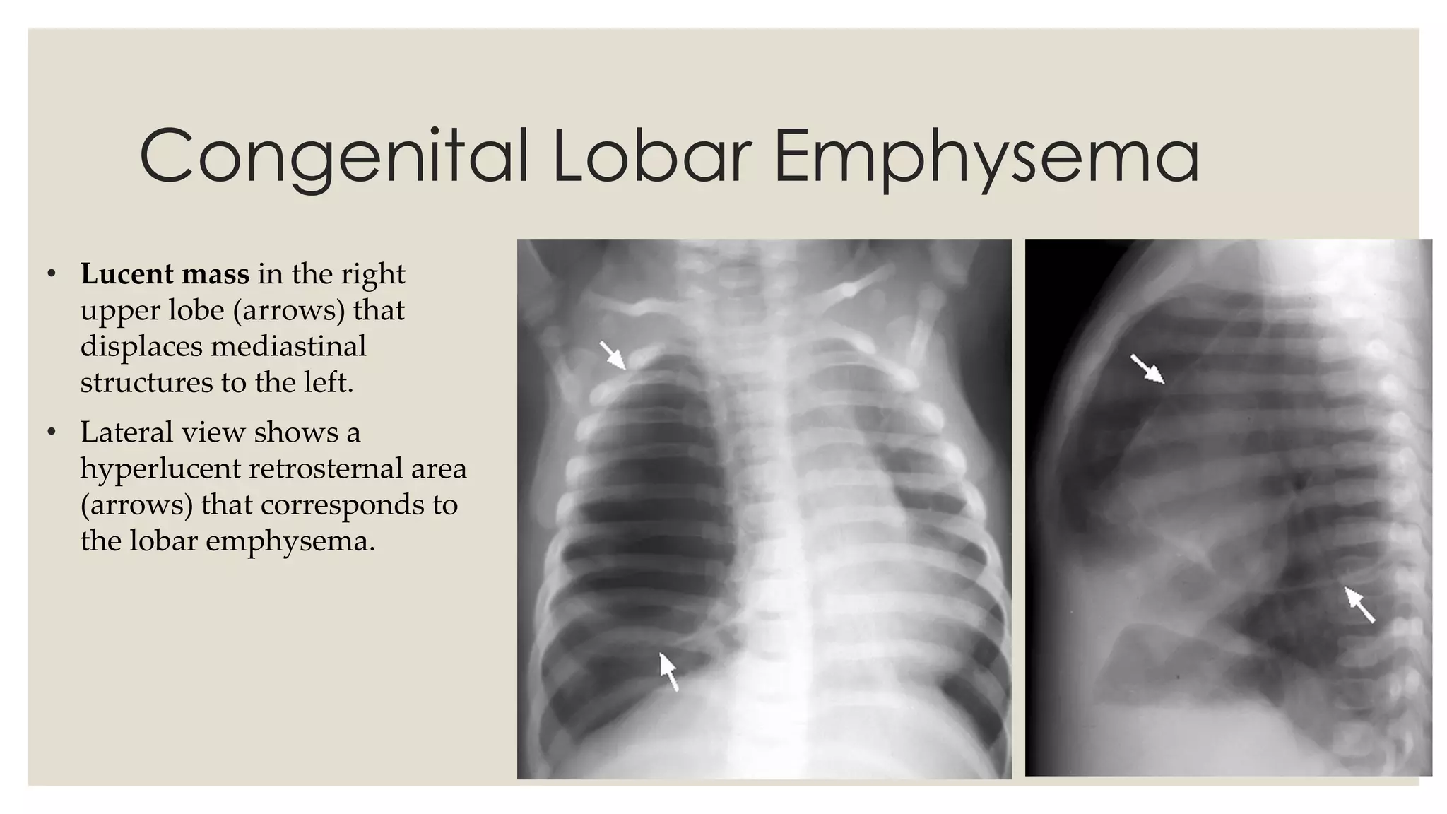 Congenital anomalies of respiratory system A Radiological approach | PDF