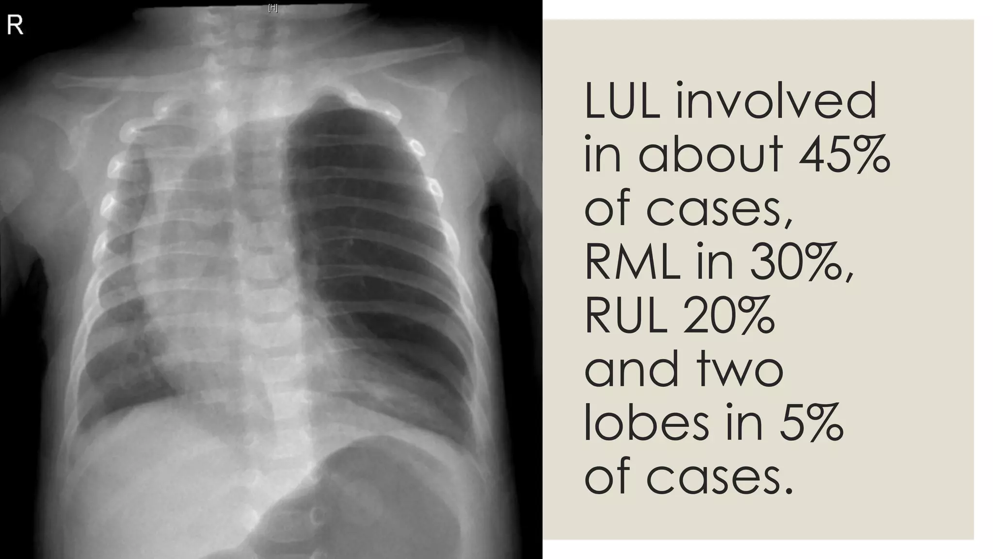 Congenital anomalies of respiratory system A Radiological approach | PDF