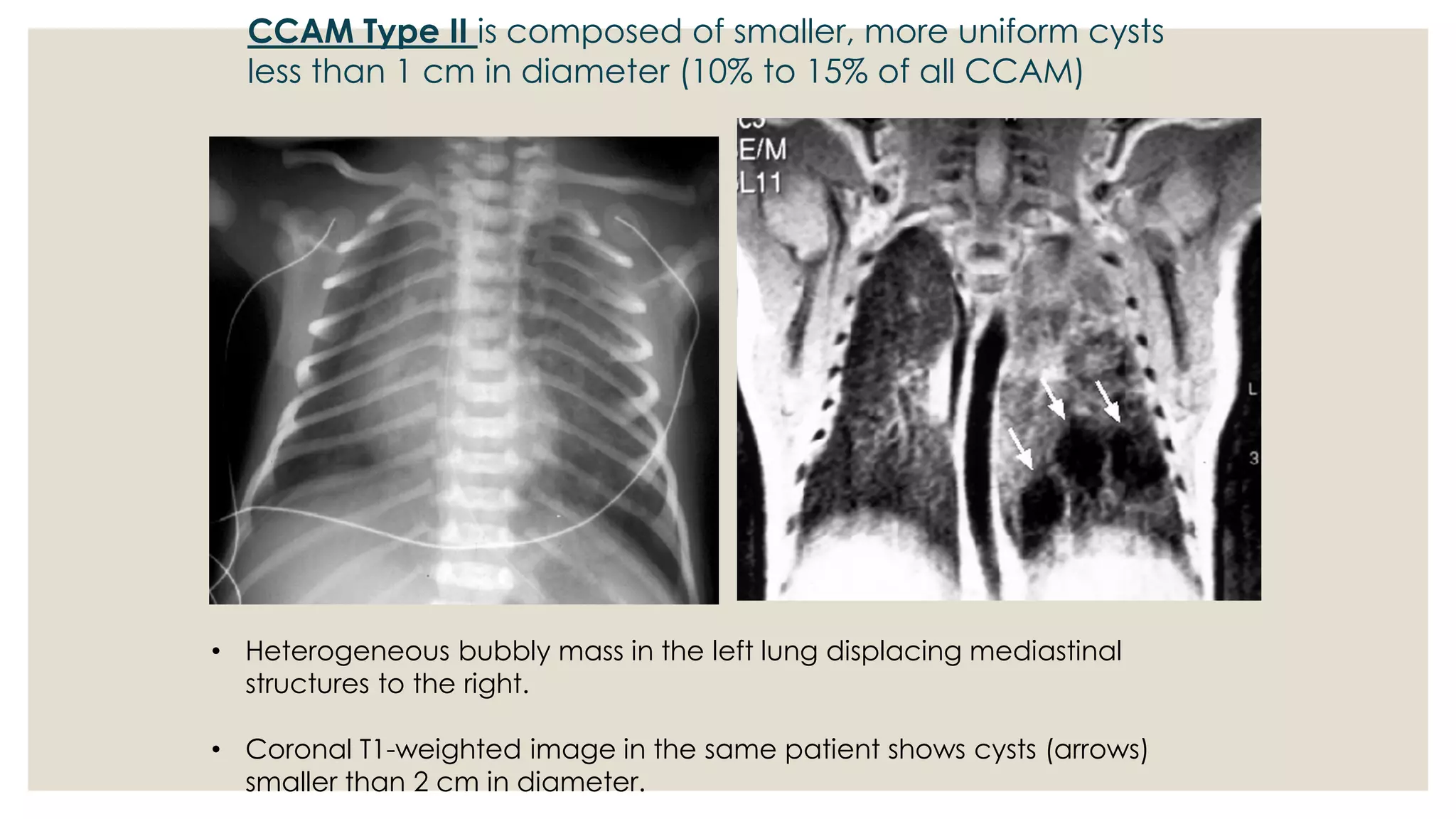 Congenital anomalies of respiratory system A Radiological approach | PDF