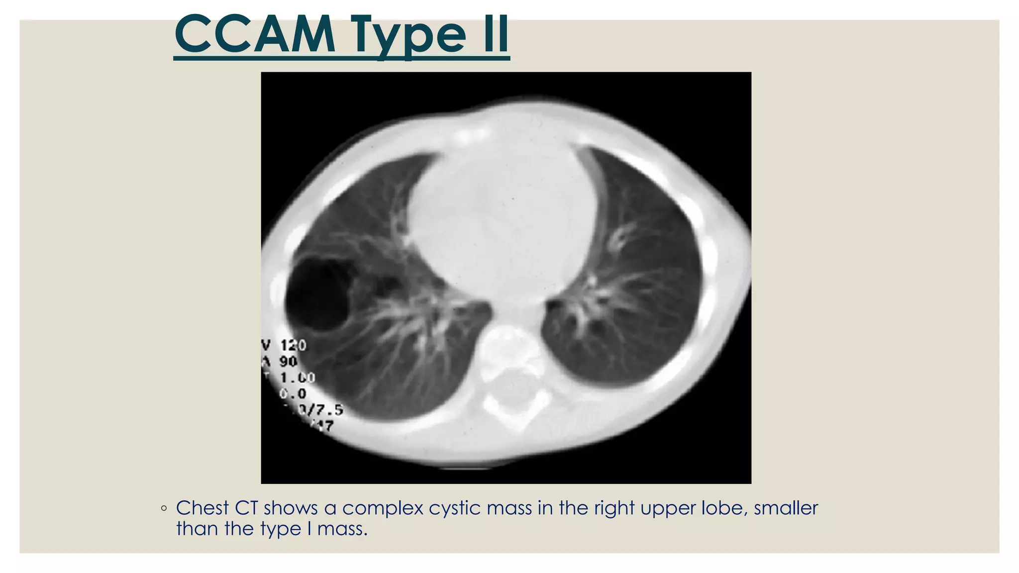 Congenital anomalies of respiratory system A Radiological approach | PDF