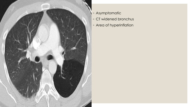Congenital anomalies of respiratory system A Radiological approach ...