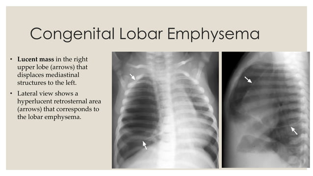 Congenital anomalies of respiratory system A Radiological approach ...