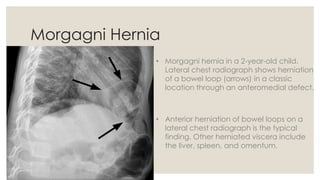 Congenital anomalies of respiratory system A Radiological approach | PDF