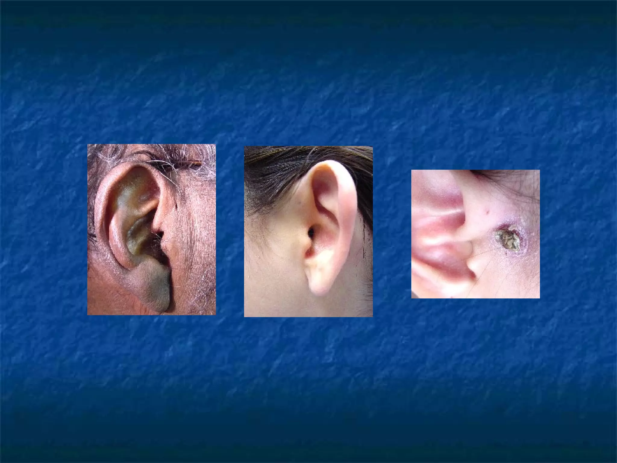 Congenital anomalies of the ear2 | PPT