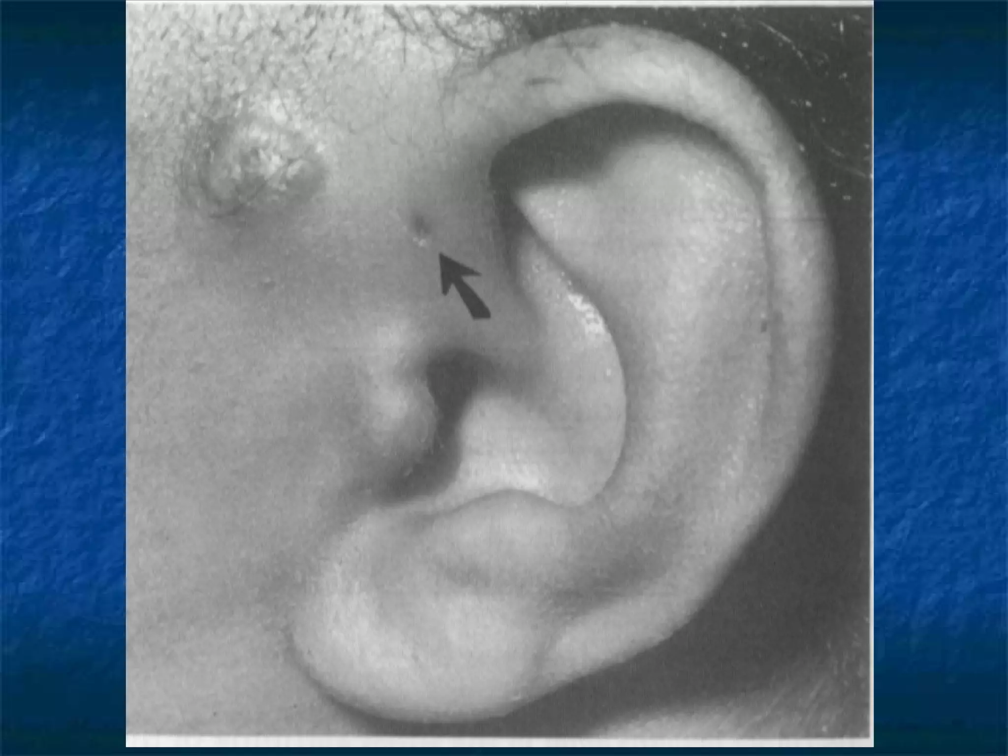 Congenital anomalies of the ear2 | PPT