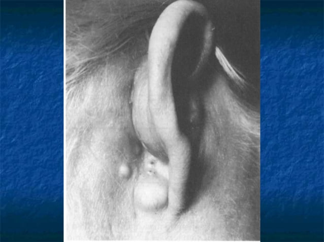 Congenital anomalies of the ear2 | PPT