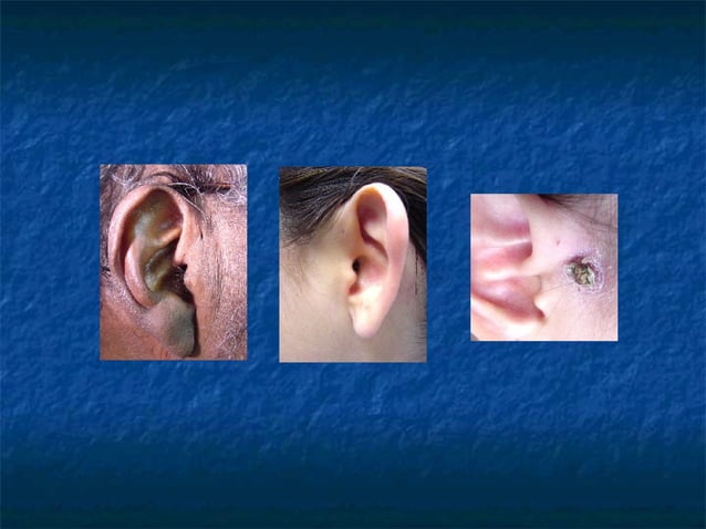 Congenital anomalies of the ear2 | PPT