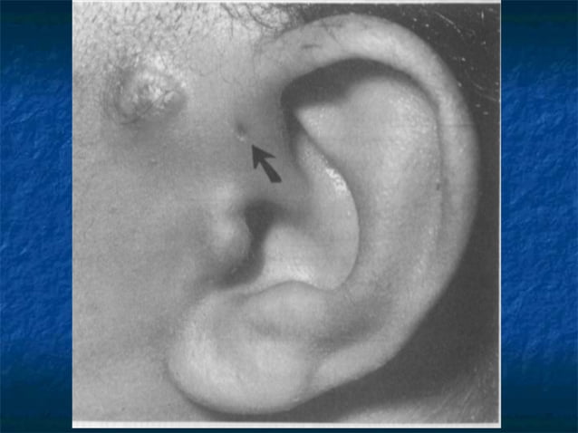 Congenital anomalies of the ear2 | PPT