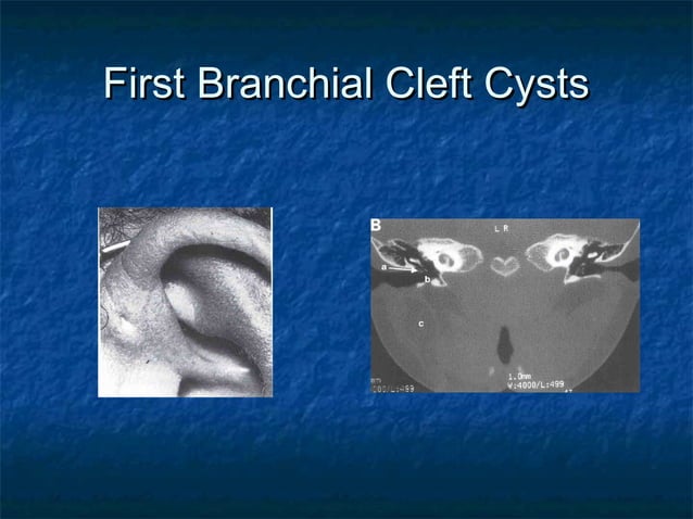 Congenital anomalies of the ear2 | PPT