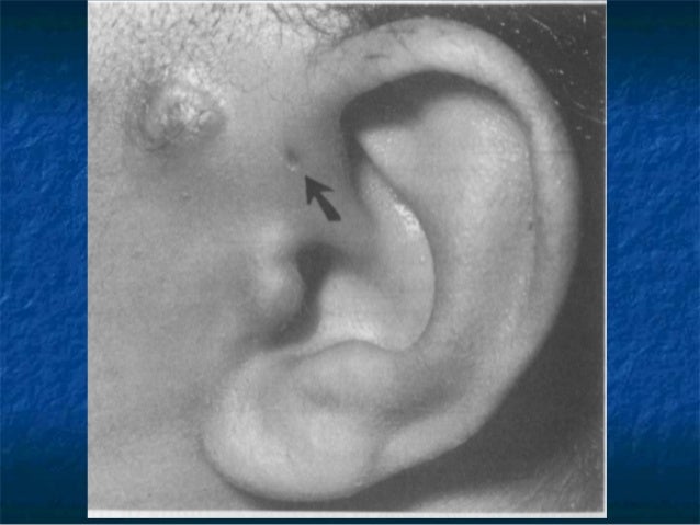 Congenital anomalies of the ear2
