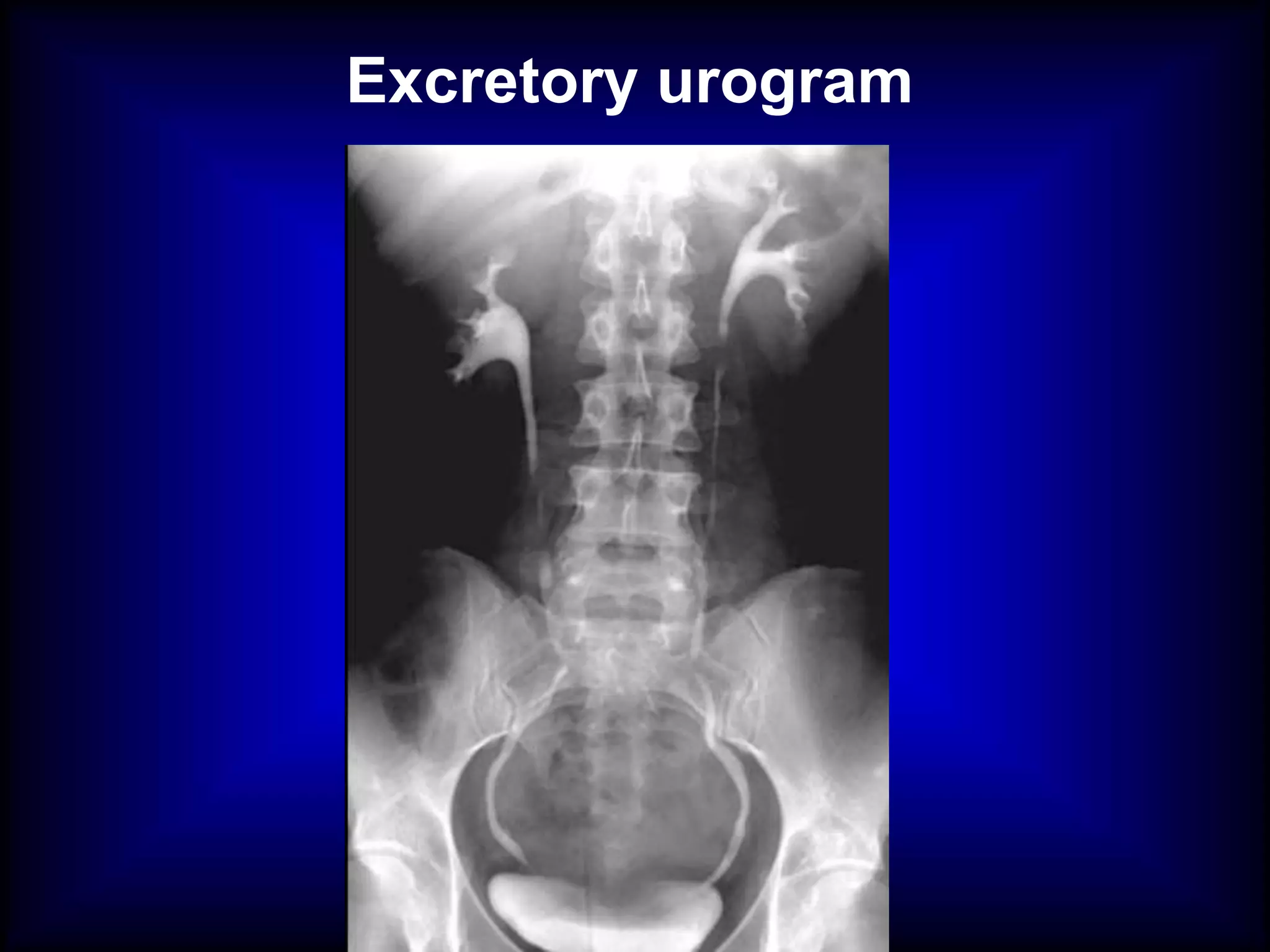 Congenital Anomalies of the Kidney and the Urinary Tract (CAKUT).ppt