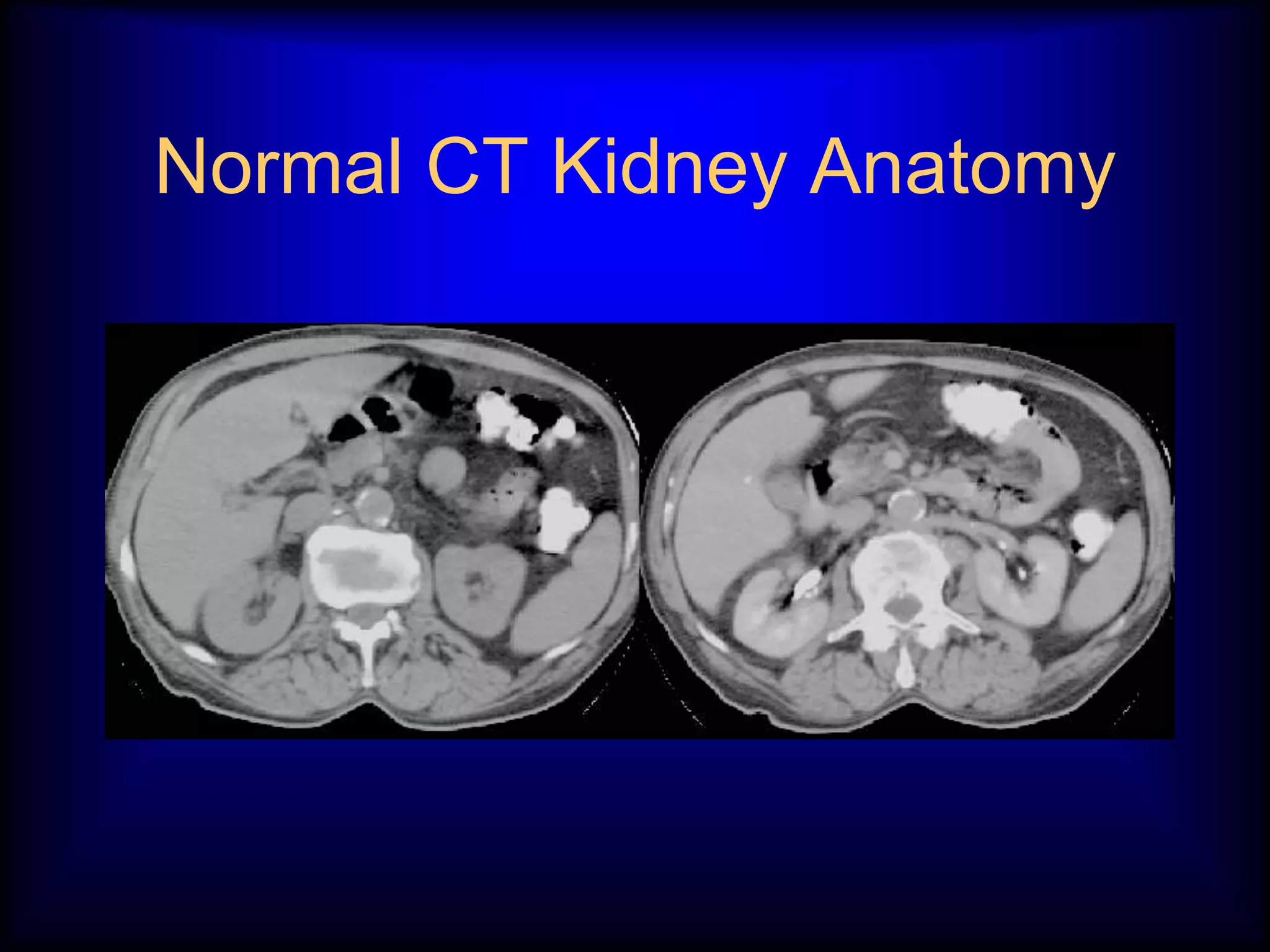 Congenital Anomalies of the Kidney and the Urinary Tract (CAKUT).ppt