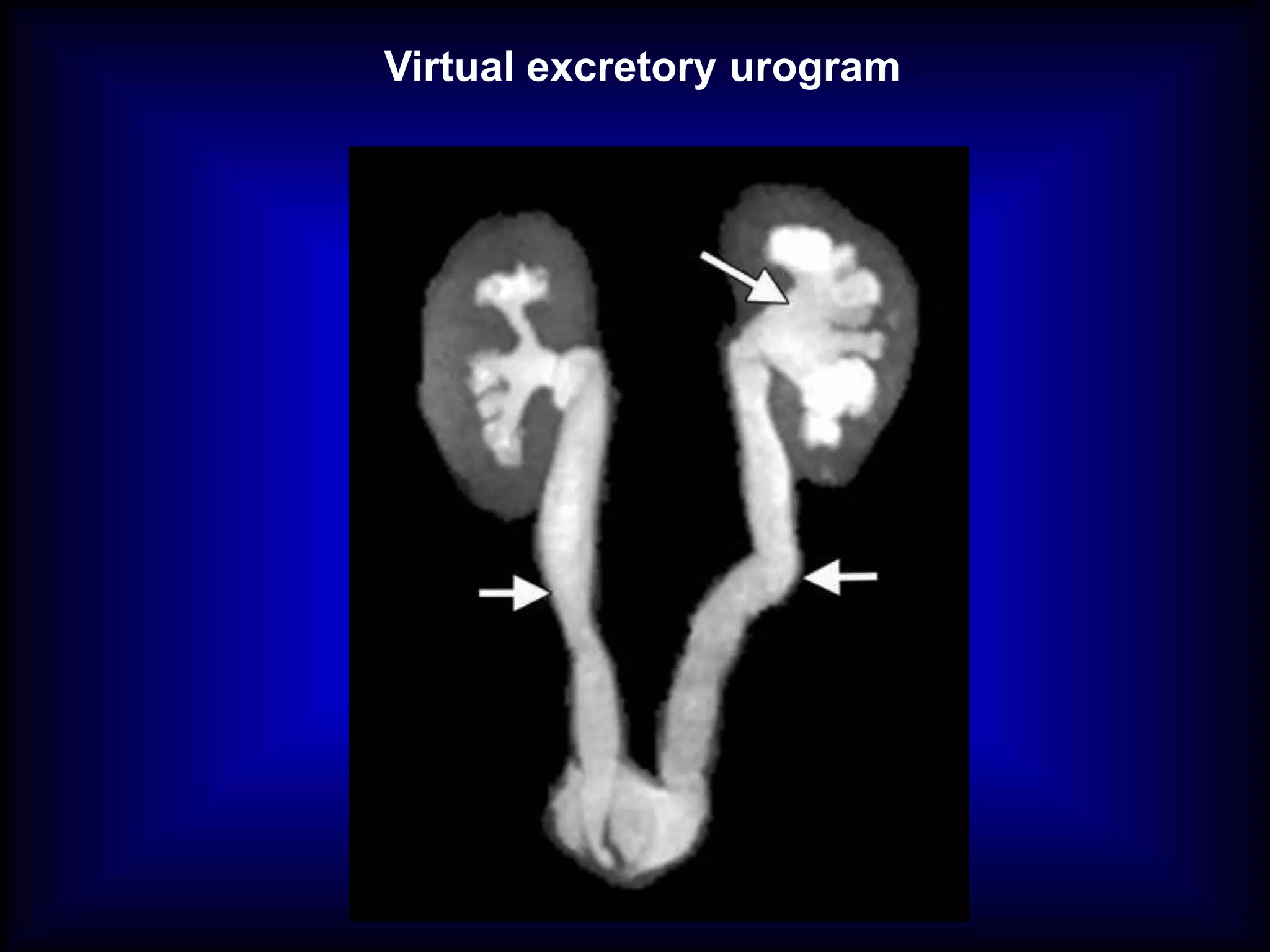 Congenital Anomalies of the Kidney and the Urinary Tract (CAKUT).ppt