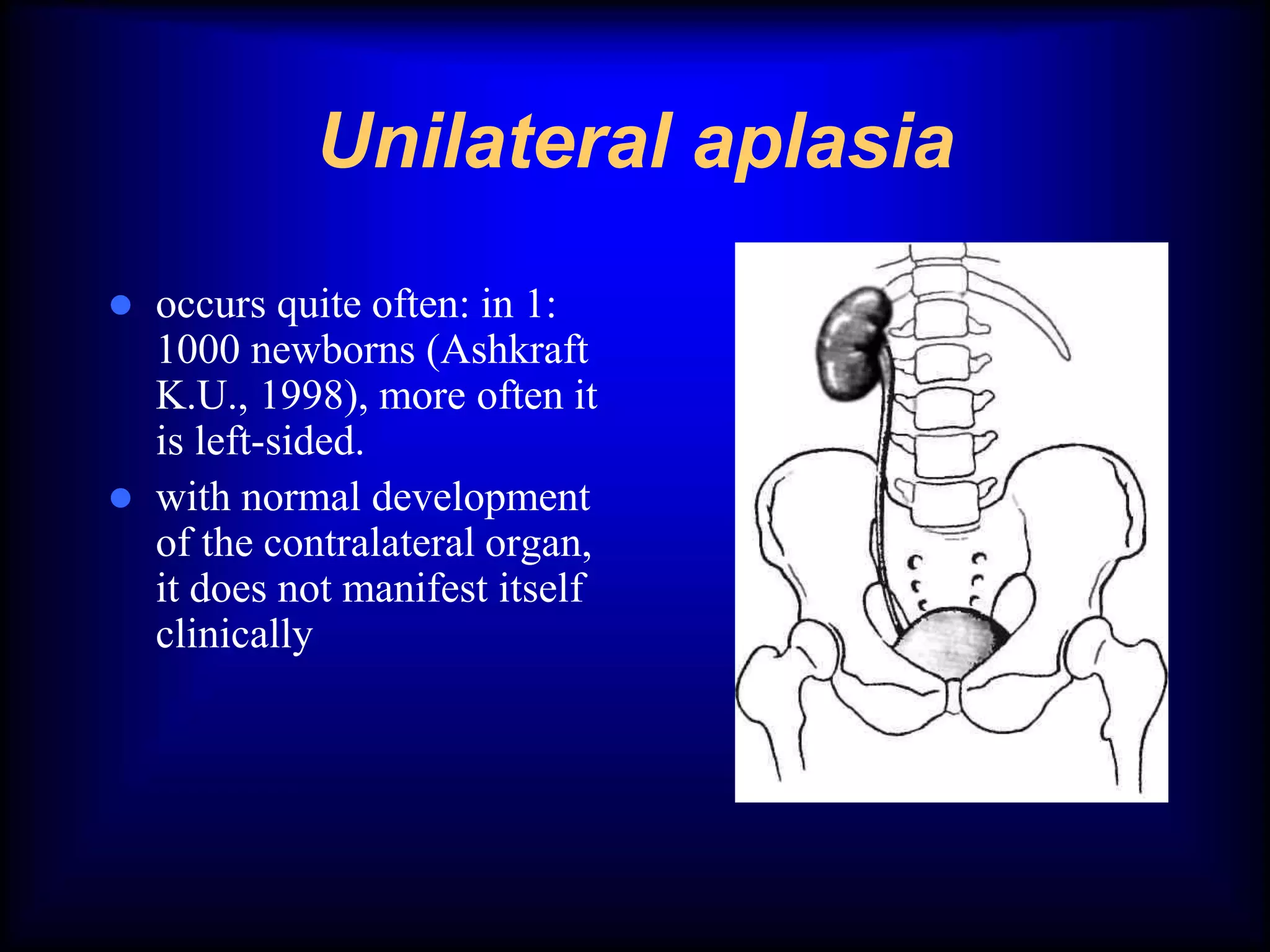 Congenital Anomalies of the Kidney and the Urinary Tract (CAKUT).ppt