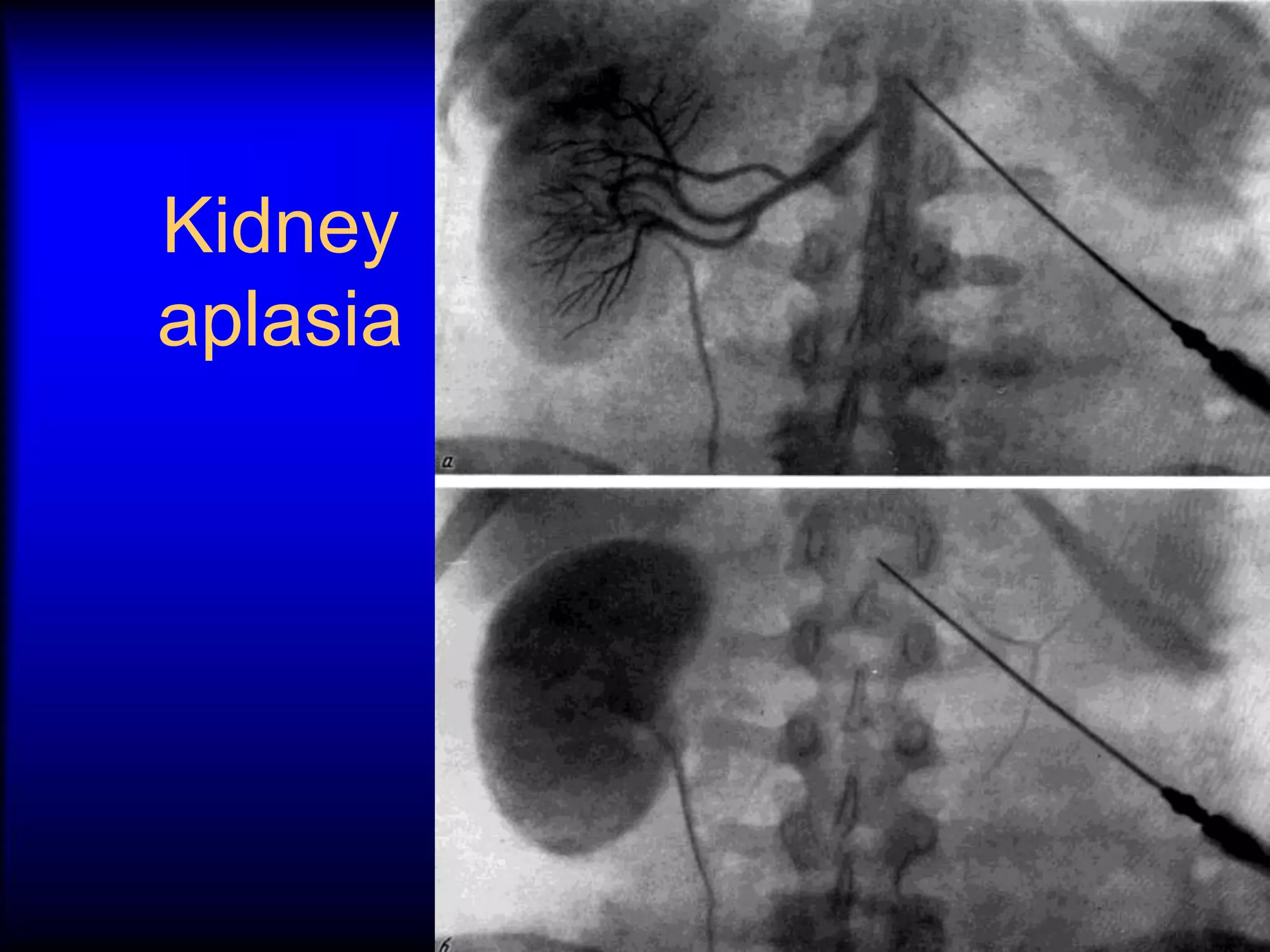 Congenital Anomalies of the Kidney and the Urinary Tract (CAKUT).ppt