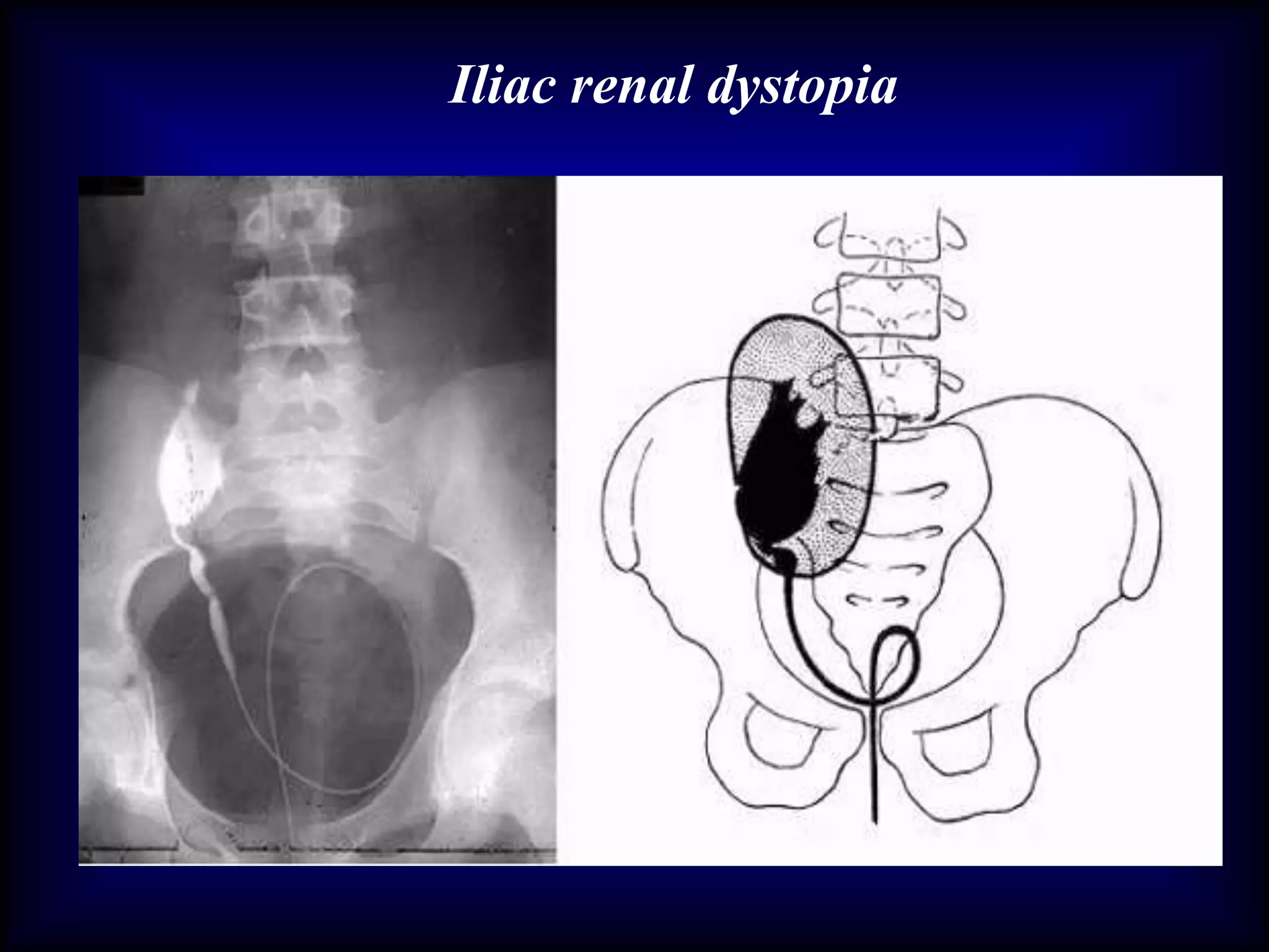 Congenital Anomalies of the Kidney and the Urinary Tract (CAKUT).ppt