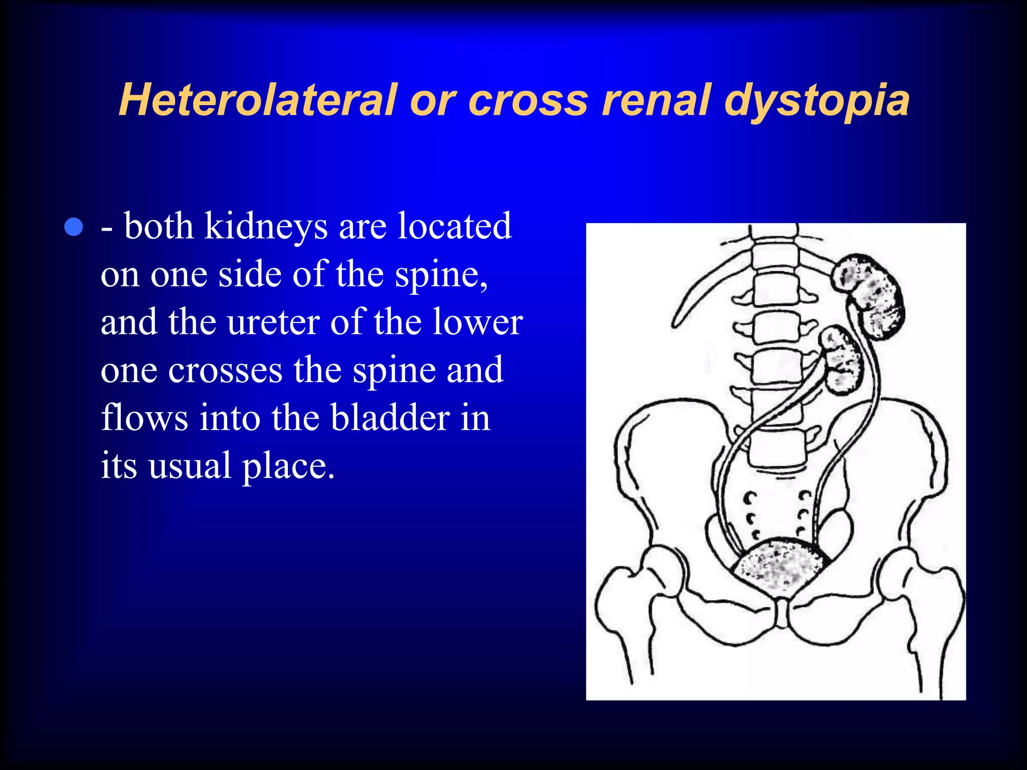 Congenital Anomalies of the Kidney and the Urinary Tract (CAKUT).ppt