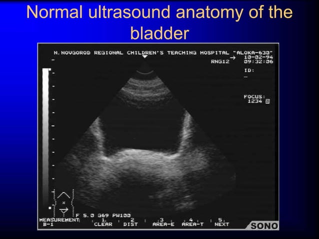 Congenital Anomalies of the Kidney and the Urinary Tract (CAKUT).ppt ...
