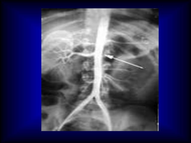 Congenital Anomalies of the Kidney and the Urinary Tract (CAKUT).ppt ...