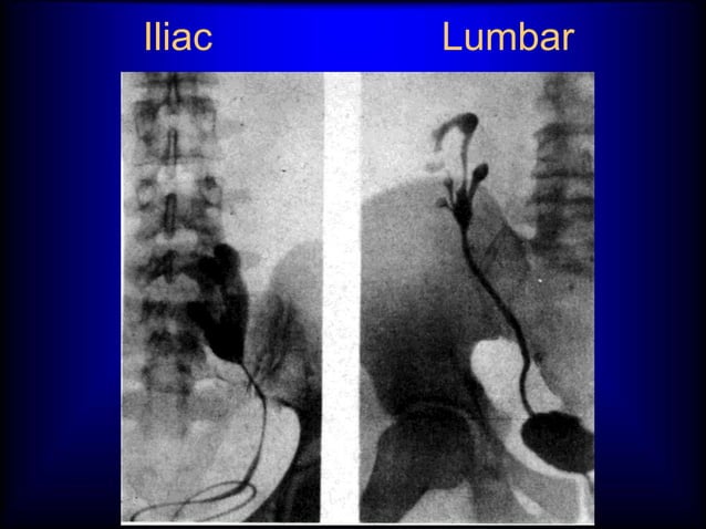 Congenital Anomalies of the Kidney and the Urinary Tract (CAKUT).ppt ...