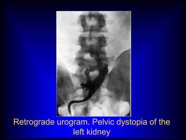 Congenital Anomalies of the Kidney and the Urinary Tract (CAKUT).ppt ...