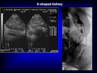 Congenital Anomalies of the Kidney and the Urinary Tract (CAKUT).ppt