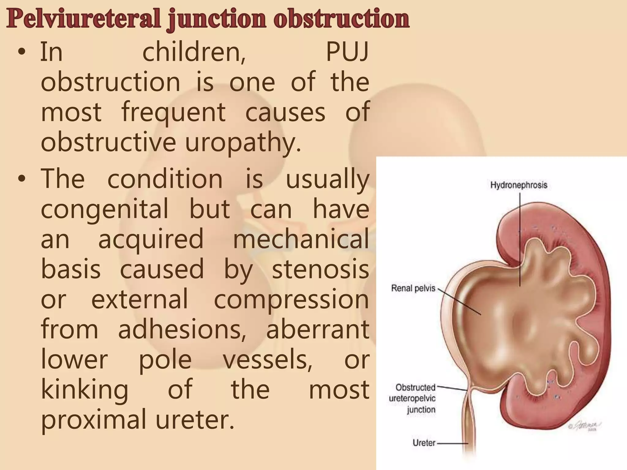 Congenital anomalies of the kidney and urinary tract | PPTX