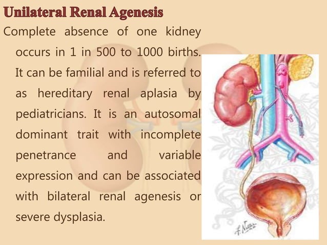 Congenital anomalies of the kidney and urinary tract | PPTX