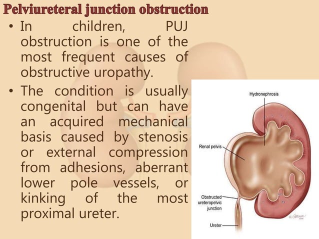 Congenital anomalies of the kidney and urinary tract | PPTX