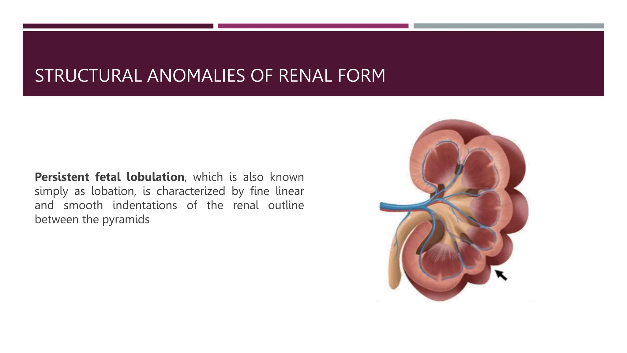 Congenital Anomalies of the Kidney & Urinary Tract | PPTX