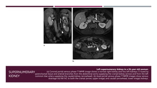 Congenital Anomalies of the Kidney & Urinary Tract | PPTX