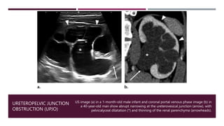 Congenital Anomalies of the Kidney & Urinary Tract | PPTX