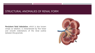 Congenital Anomalies of the Kidney & Urinary Tract | PPTX
