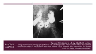 Congenital Anomalies of the Kidney & Urinary Tract | PPTX