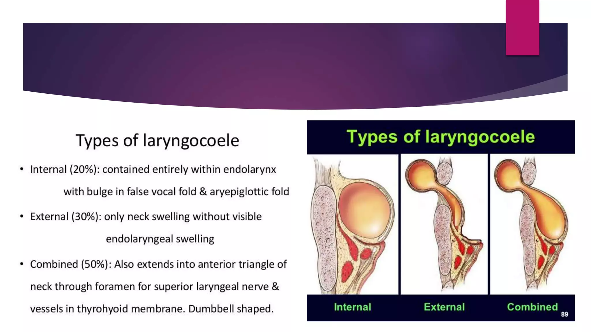 Congenital anomalies of the larynx | PPTX