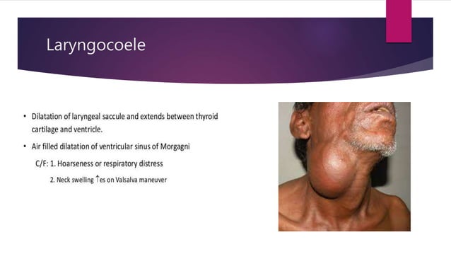 Congenital anomalies of the larynx | PPTX | Ear, Nose and Throat ...