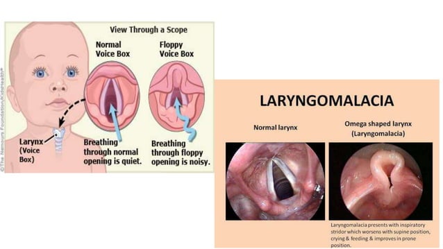 Congenital anomalies of the larynx | PPTX | Ear, Nose and Throat ...
