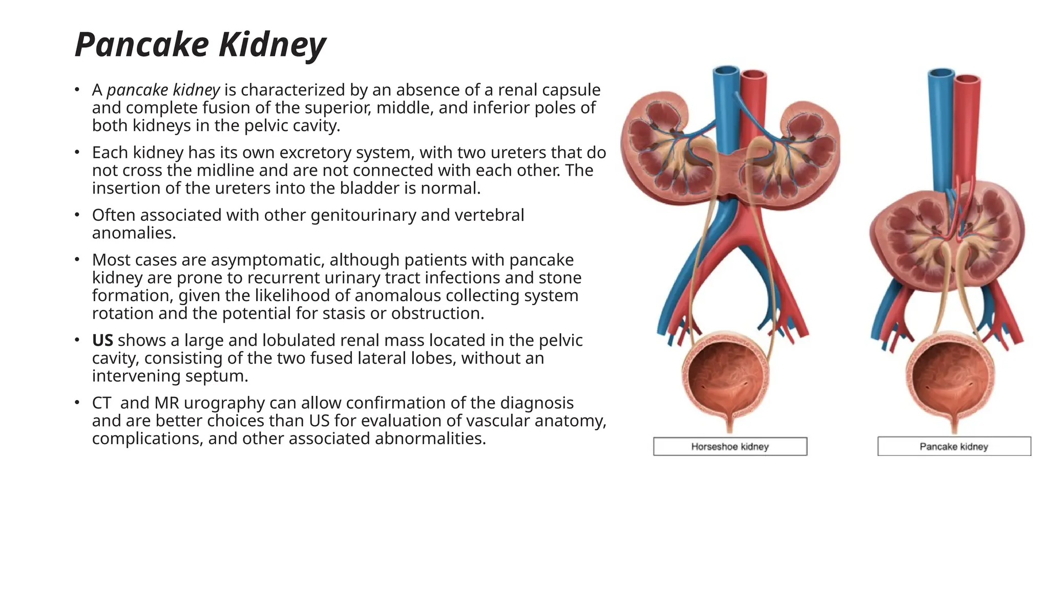 Congenital Anomalies of the Urinary tract | PPTX