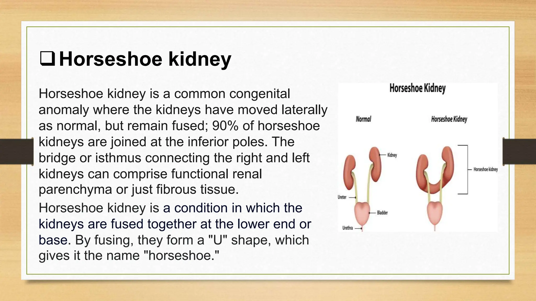 Congenital Anomalies Of UG System PATHOLOGY.pptx